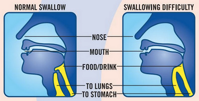 Swallowing | Lear Communication
